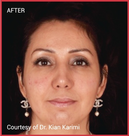 ezPRF · Platelet Rich Fibrin