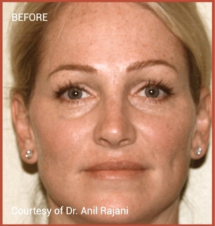 ezPRF · Platelet Rich Fibrin