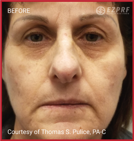 ezPRF · Platelet Rich Fibrin