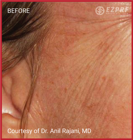 ezPRF · Platelet Rich Fibrin