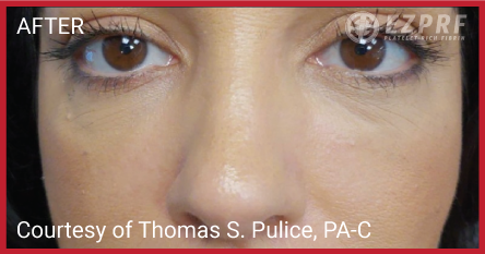 ezPRF · Platelet Rich Fibrin