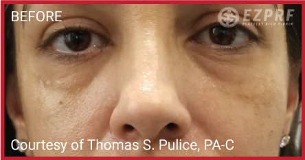 ezPRF · Platelet Rich Fibrin