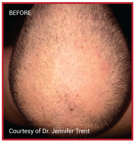 ezPRF · Platelet Rich Fibrin